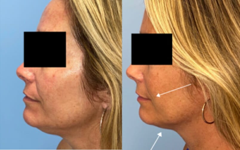 Sofwave - Evolution Dermatology and Wellness